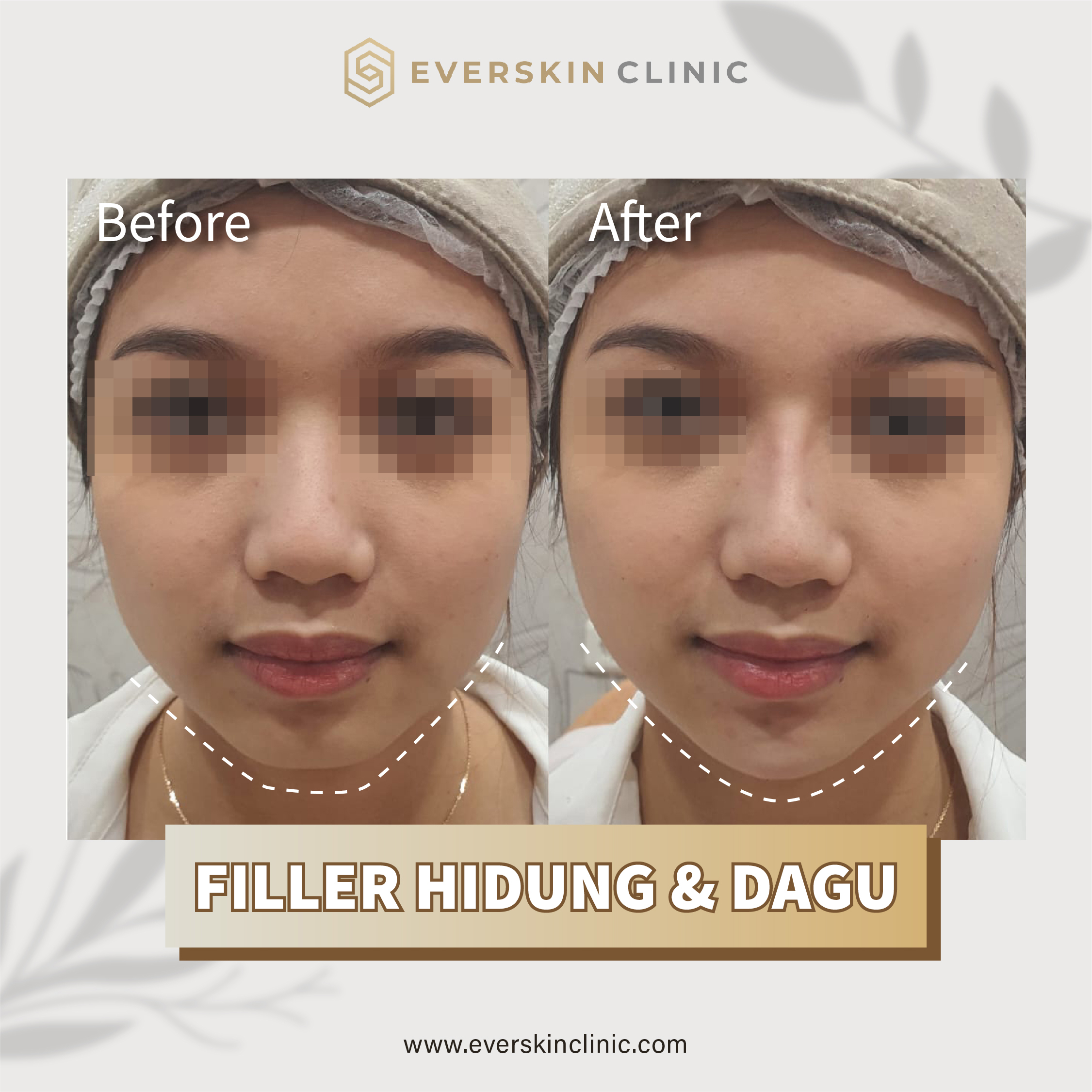 Face Contouring by Everskin | Bridestory.com