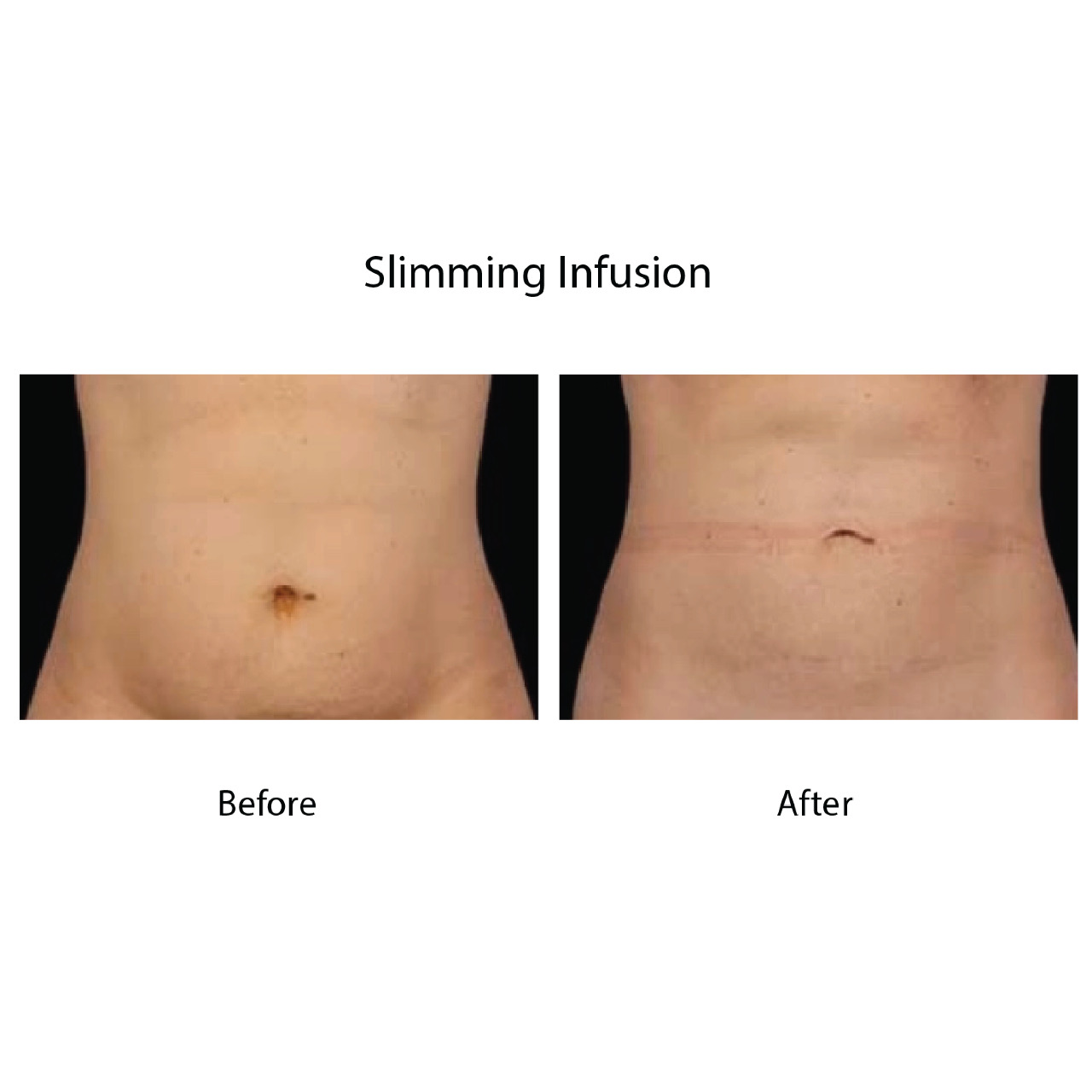 4x Slimming infusion Treatment oleh la lumiere aesthetics | Bridestory ...