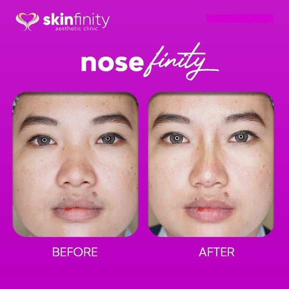 Treatment Hidung | Skinfinity Aesthetic Clinic | Bridestory